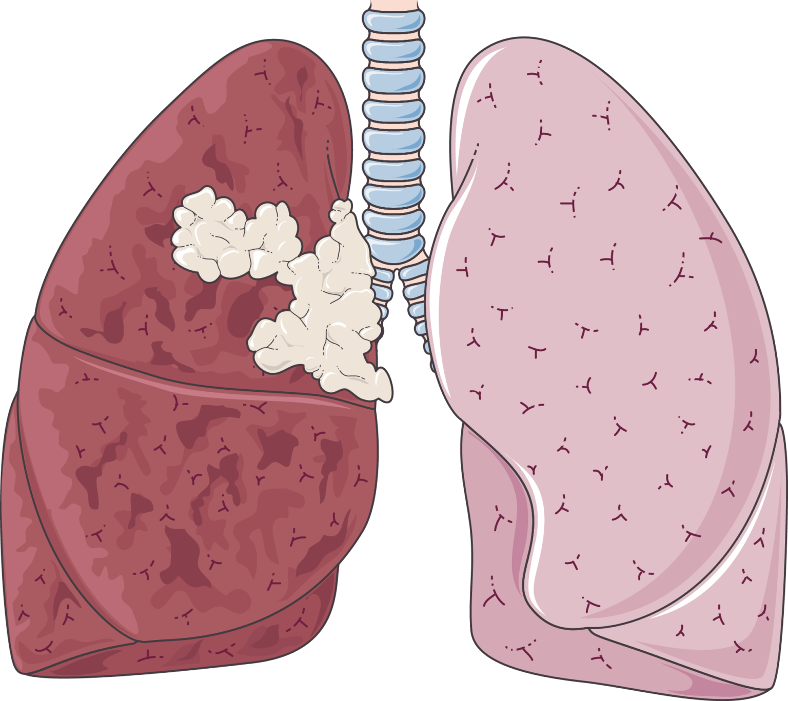 Lungs - Servier Medical Art