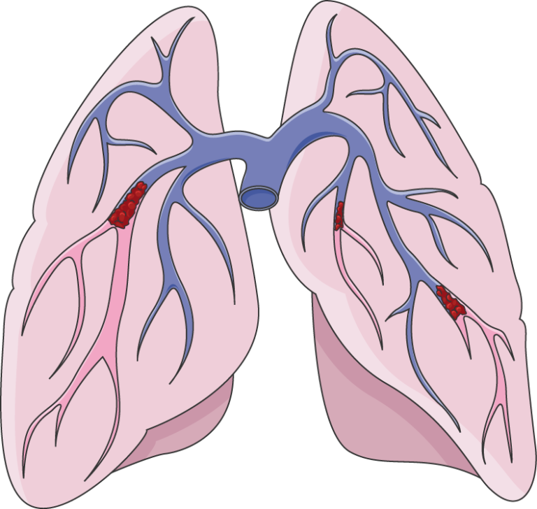 Inflamed bronchus - Servier Medical Art