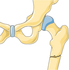 Fracture cascade - Servier Medical Art