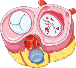 Endocarditis - Servier Medical Art